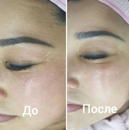 Акция 1 октябрдан 10 октябргача чистка, карбоксотерапия, мезотерапия