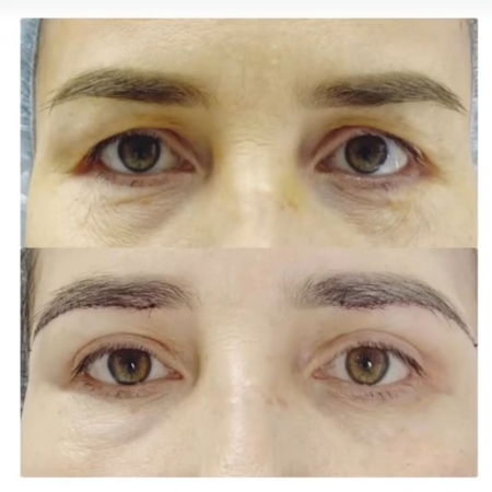 SKIDKADA (Bezoperatsonniy Sangapuri) Browlifting muolajasi