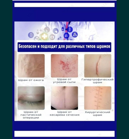 Силиконовый пластырь Elaimei для лечения шрамов и рубцов